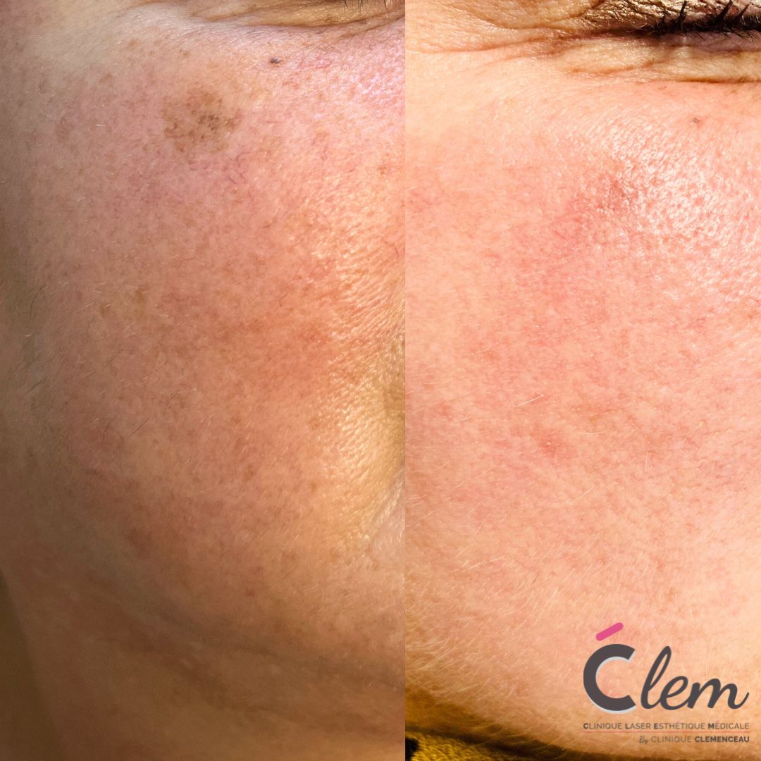 OPL PIGMENTAIRE - CLEM