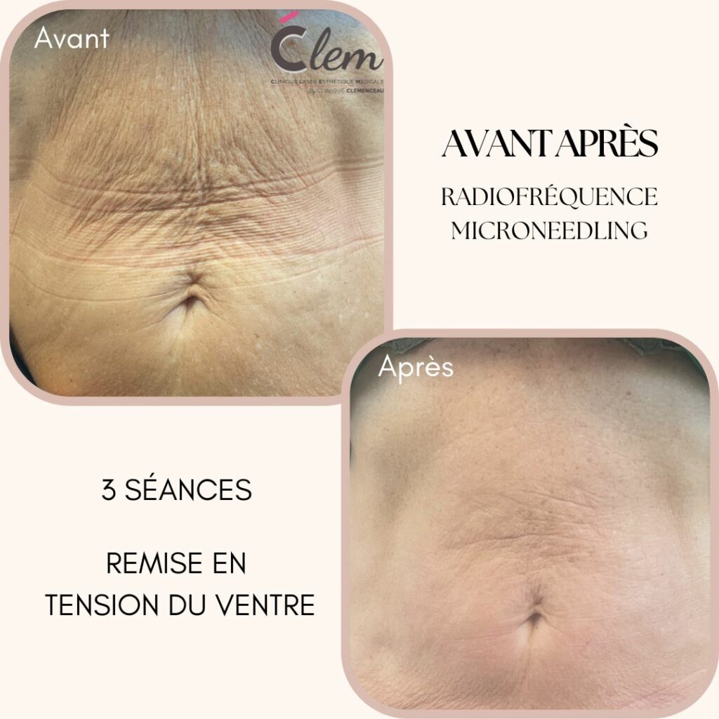 Radiofréquence microneedling - CLEM