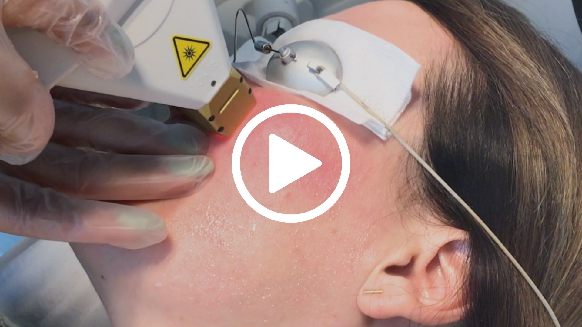 Vidéo - Le traitement des rougeurs avec le laser OPL vasculaire - CLEM